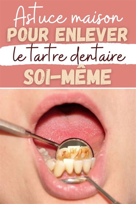 Le détartrage dentaire est un acte médical qui doit seffectuer par un