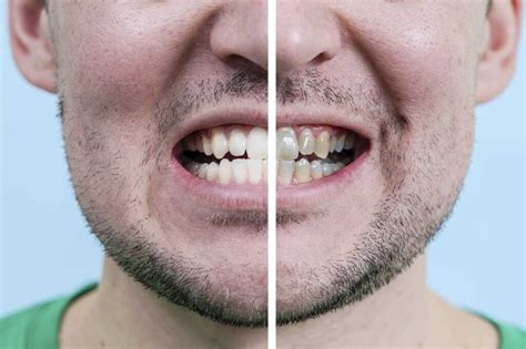 Carillas de Zirconio Transformaciones Antes y Después Blog Dental Irriak