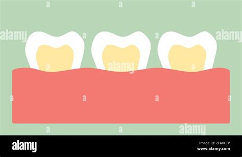 Stages Of Tooth Decay Stock Videos Footage HD And 4K Video Clips