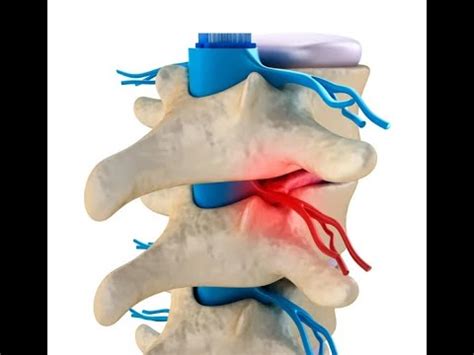 Laminotomy Laminectomy Hemilaminectomy Foraminotomy Facetectomy