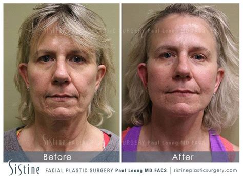 Facelift Before And After Sistine Facial Plastic Surgery Facial Plastic Surgery Facial