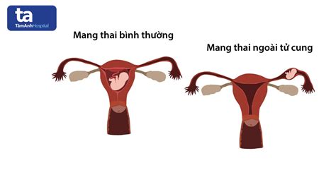 Mang thai ngoài tử cung Nguyên nhân Triệu chứng thường gặp