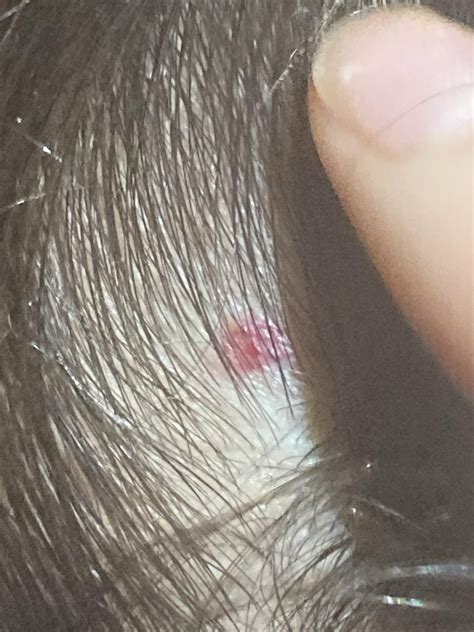 Red Bump On Scalp Rdermatologyquestions