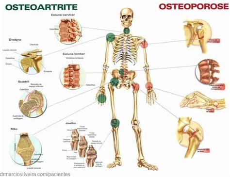 Qual A Diferença Entre Artrite Artrose Osteoporose Osteoartrite E