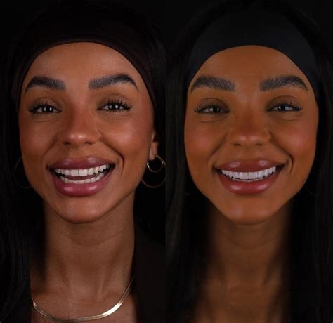 Brunna Gonçalves mostra antes e depois de sorriso após colocar lentes veja