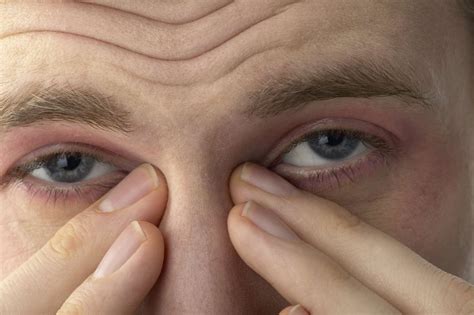 Swollen Lacrimal Gland