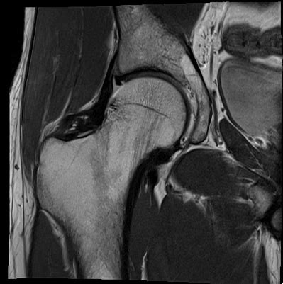 Hip Coronal MRI Diagram Quizlet