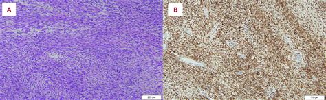 A Microscopic Image Of The Biopsy Specimen Hematoxylin Eosin HE