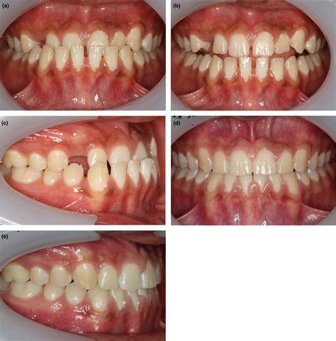 Timing Orthodontic Treatment Early Or Late Fleming 2017