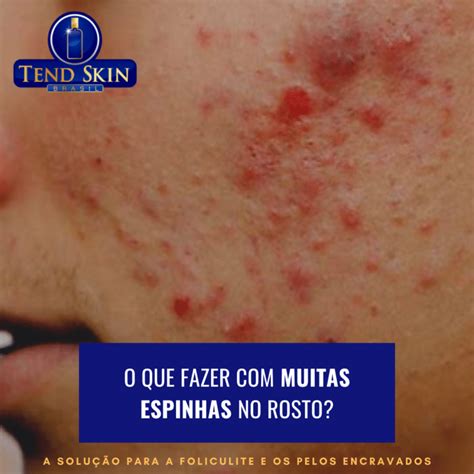 O Que Fazer Muitas Espinhas No Rosto
