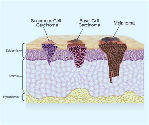 Skin Lesions Skin Help