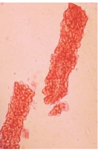 Medstudy Nephrology Flashcards Quizlet