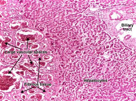 Liver Pathology Flashcards Quizlet