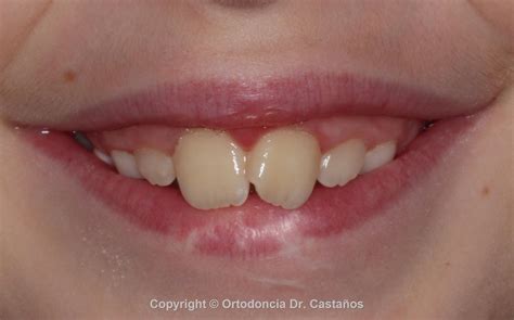 Interposición Lingual Labial y dientes adelantados Ortodoncia Castaños