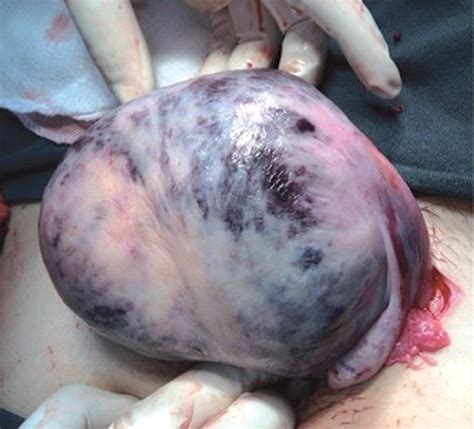 Descolamento Prematuro de Placenta tudo que você precisa saber