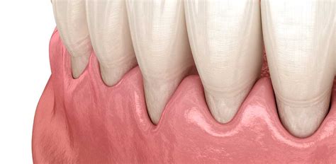 How To Fix Receding Gums IMPLANT PERIO CENTER