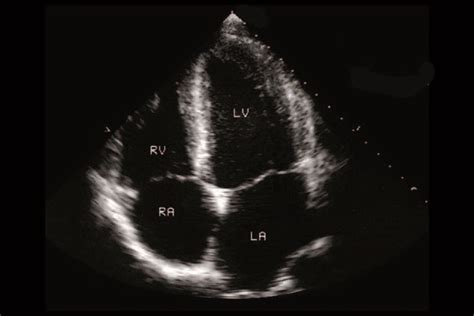 Echocardia Wiki
