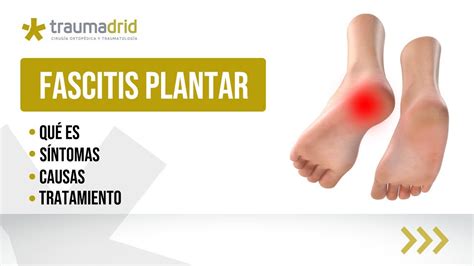 Qu Es La Fascitis Plantar El Doctor Ruiz Mezcua Te Cuenta Lo Que