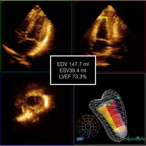 D Echocardiography Demonstrating The Modified Simpson S Method In The