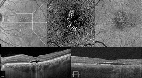 Infrared Reflectance IR Optical Coherence Tomography OCT And