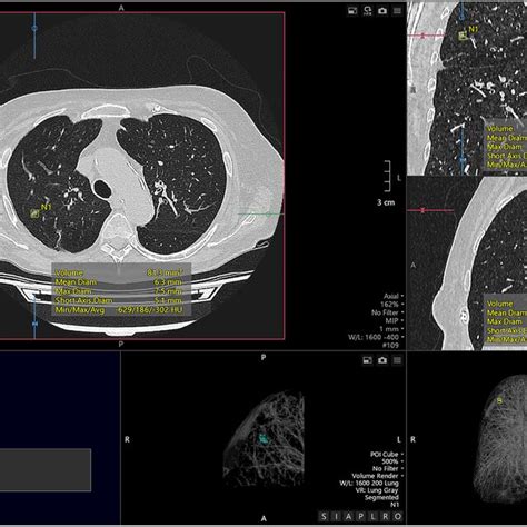 Automatic Segmentation Of A Pulmonary Nodule Identified On Chest Ct By