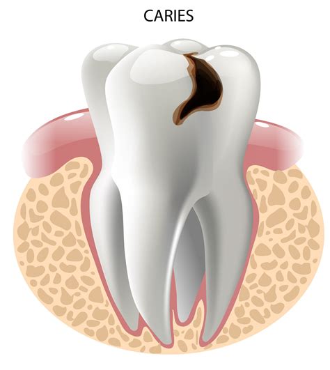 Qué son las caries dentales causas y tratamientos Solución Dental