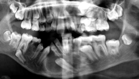 Odontogenic Keratocyst OKC Exodontia