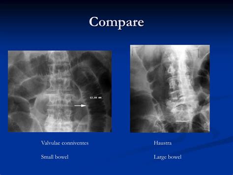 PPT Radiography Of The GI System PowerPoint Presentation Free