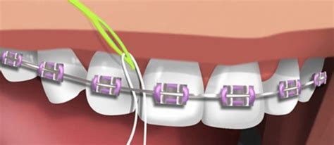 Como Usar Fio Dental Corretamente Entenda MaisOdonto