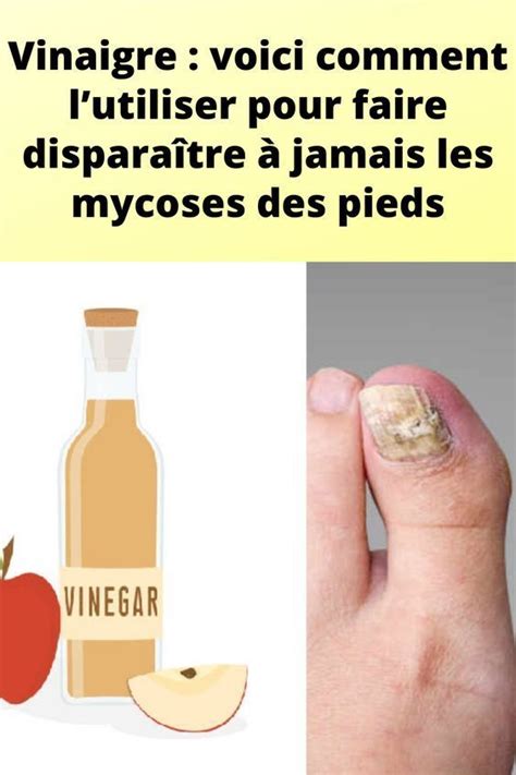 Une Recette Efficace Pour La Mycose Des Ongles Avec Du Bicarbonate De