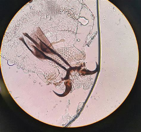 External Ophthalmomyiasis By Oestrus Ovis A Case Report From