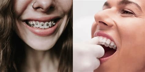 Cu Nto Cuestan Los Brackets Invisibles