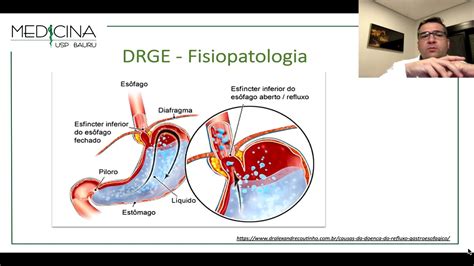 DRGE Doença do Refluxo Gastroesofágico MÓDULO 14 YouTube