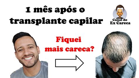 1 mês após o transplante capilar YouTube