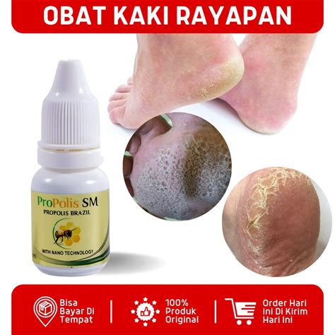Jual Obat Kaki Rayapan Telapak Kaki Bolong Telapak Kaki Berlubang