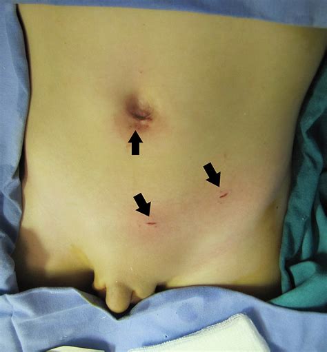 Laparoscopic Excision Of Patent Processus Vaginalis For Pediatric