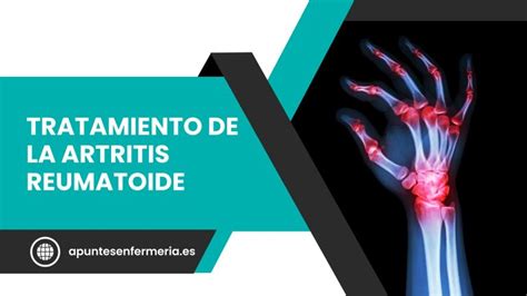 Tratamiento de la artritis reumatoide Apuntes enfermería