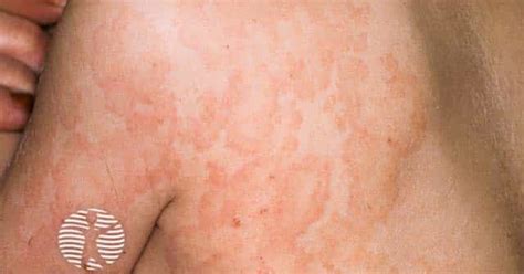DermNet Linear IgA Bullous Disease Image