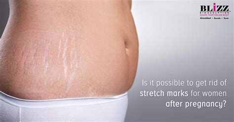 Stretch Marks During And After Pregnancy
