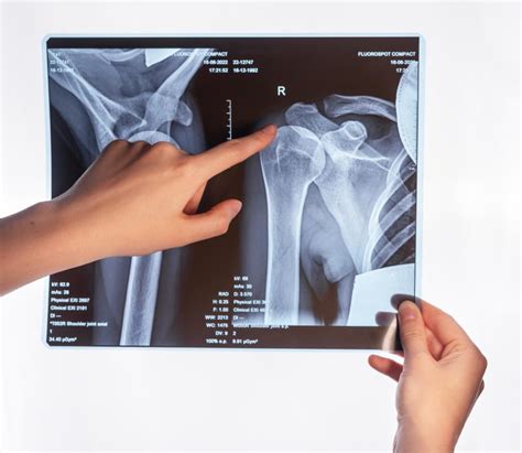 Tendinopat A Calcificada Causas S Ntomas Y Tratamientos Resobert