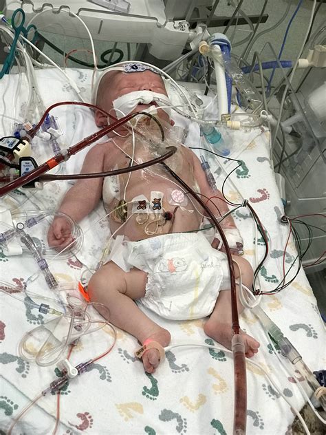 Open Chest Ecmo