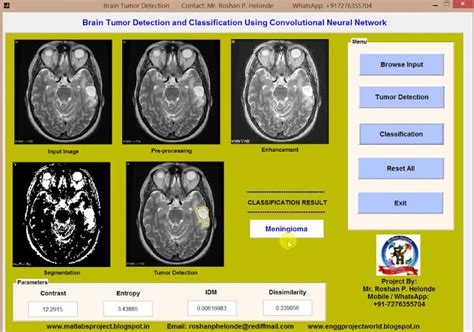 brain tumor detection using convolutional neural network cnn ~ matlab project codes