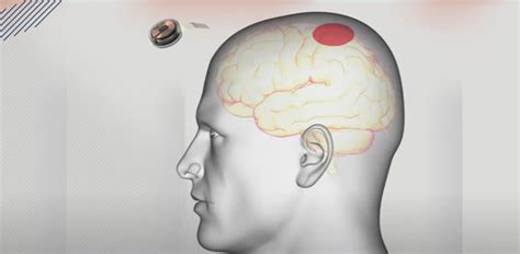 Avance histórico Neuralink de Elon Musk completa el primer implante