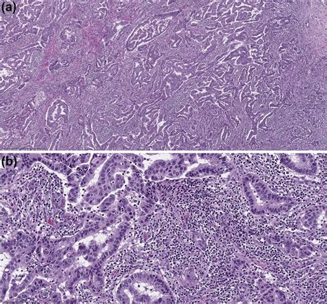 Example Of Tumor Infiltrating Lymphocytes In A Discordant Case