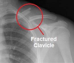 Clavicle Fracture Symptoms Diagnosis Treatment
