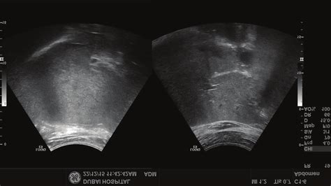 Ultra Sonography Showed Nearly Resolving Biloma With Persistence Of A