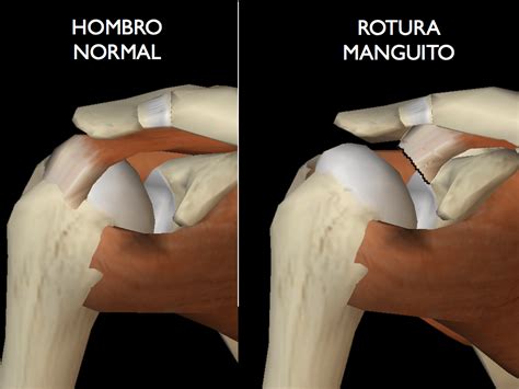 Rotura del manguito de los rotadores Clínica Martín Gómez