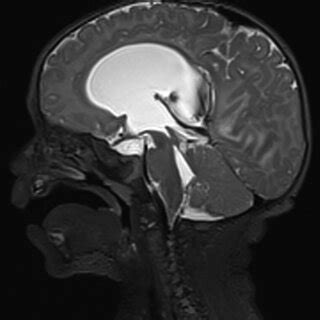 Preoperative Sagittal T2 Weighted Magnetic Resonance MR Image