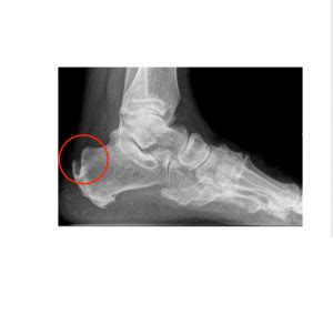 Enthésopathie calcifiante du tendon d Achille Dr Bovier Lapierre