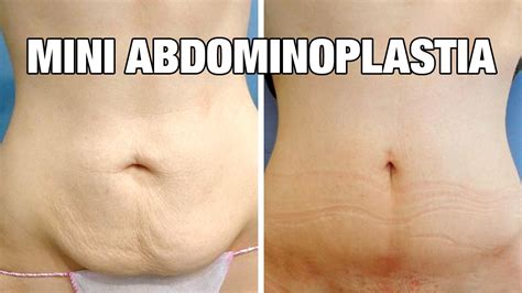 Mini Abdominoplastia antes y después Testimonio Cristina YouTube